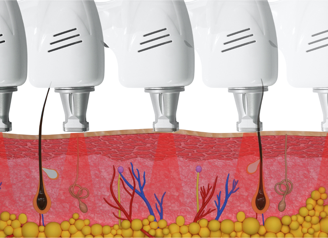 XLASE PLUS - TECHNICAL SPECIFICATIONS AND FOCUS ON THE TECHNOLOGY ...