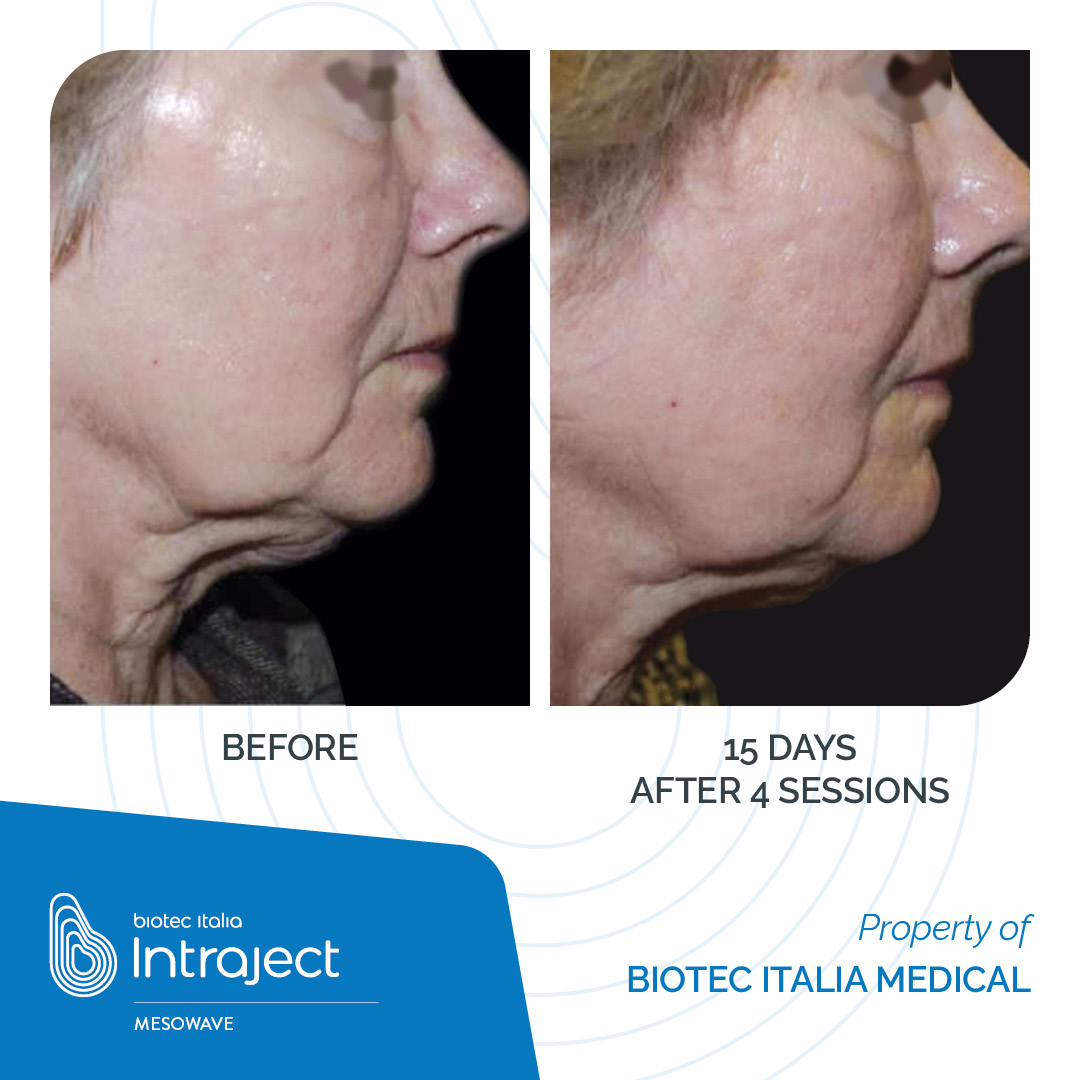 Intraject - Biotec Italia