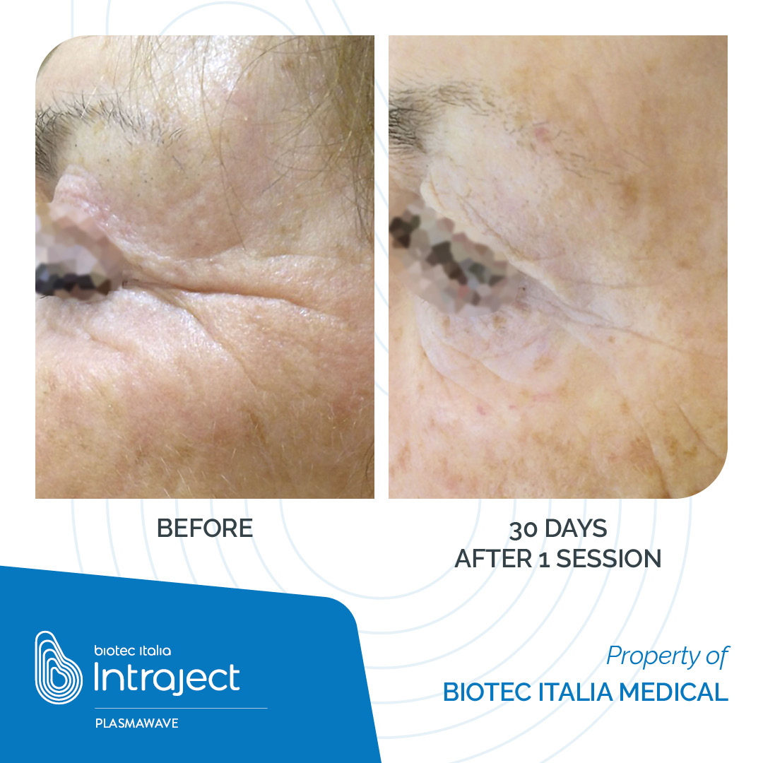 Intraject - Biotec Italia