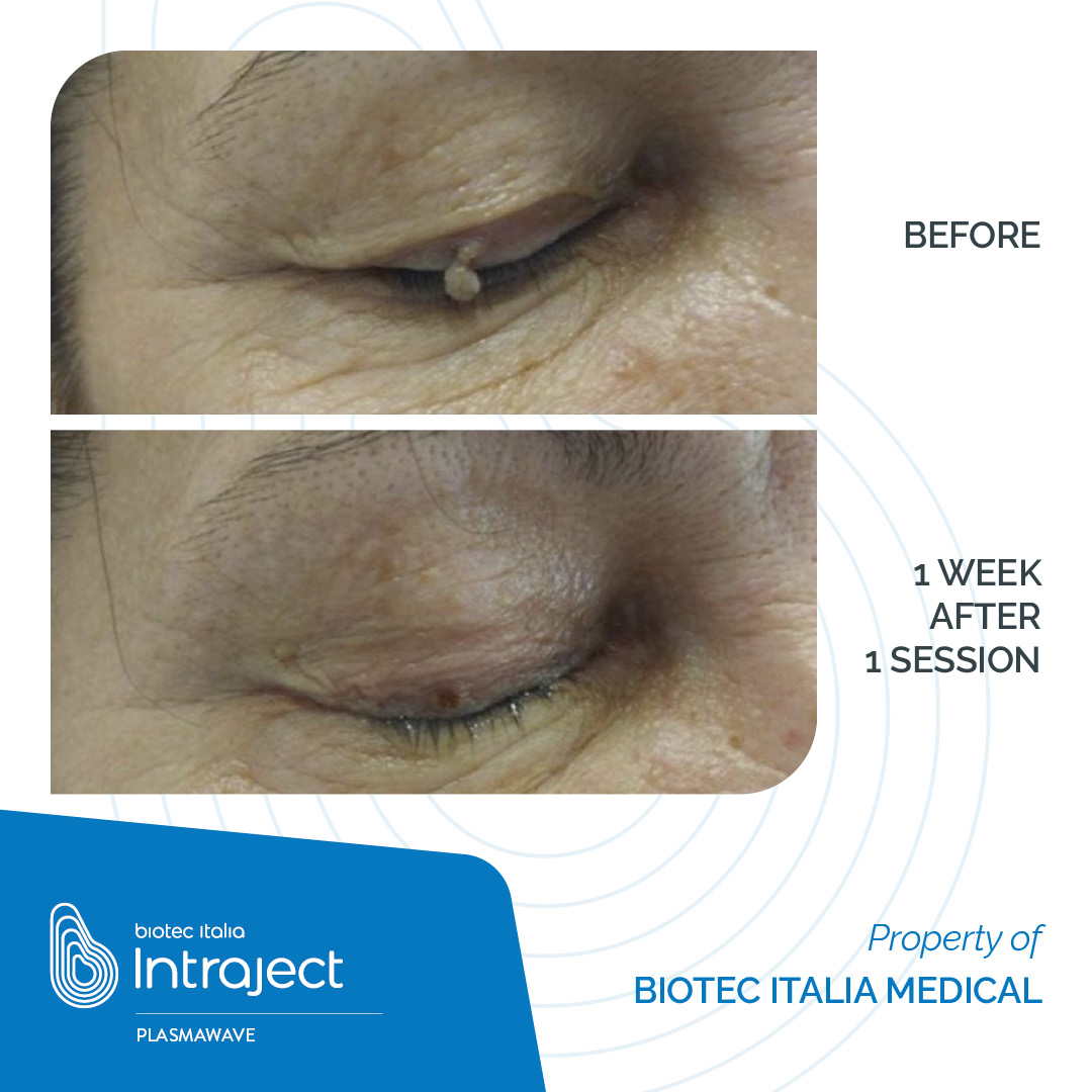 Intraject - Biotec Italia