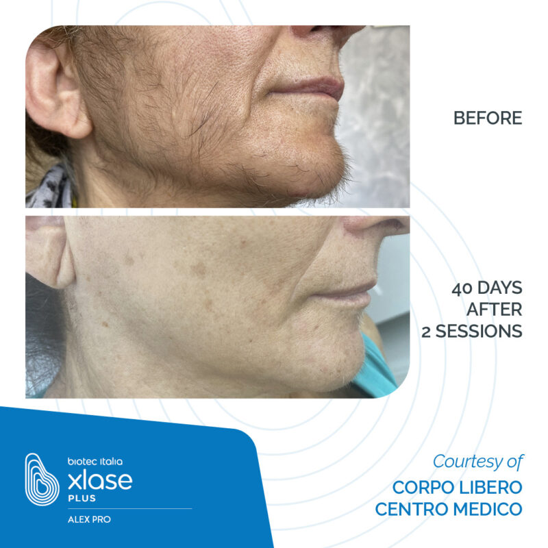 Xlase Plus - Biotec Italia