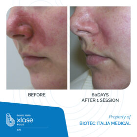 Xlase Plus - Biotec Italia