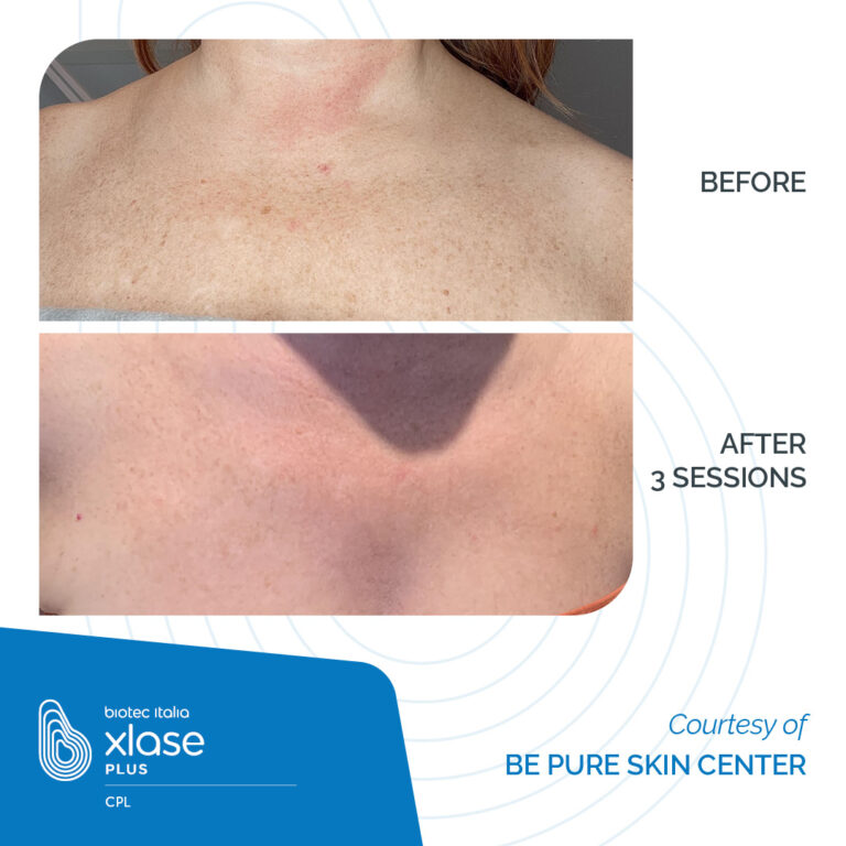 Xlase Plus - Biotec Italia