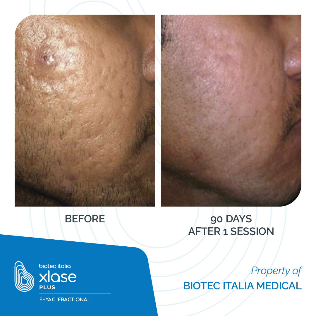 Xlase Plus - Biotec Italia