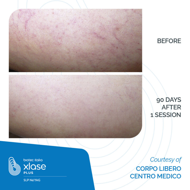 Xlase Plus - Biotec Italia