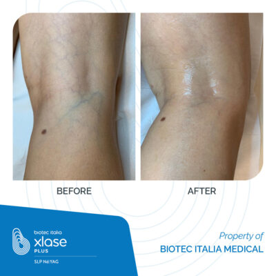 Xlase Plus - Biotec Italia