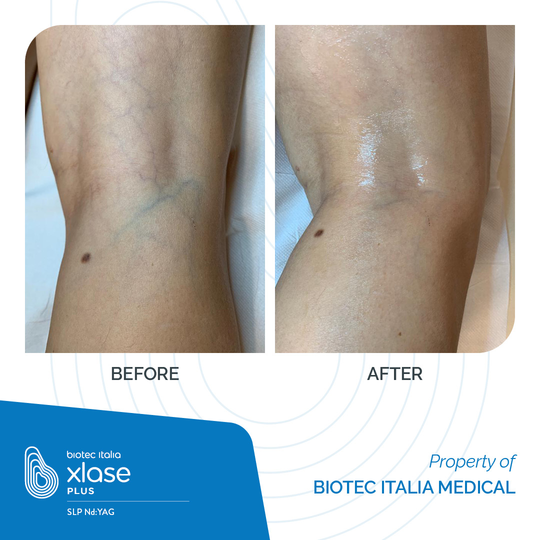 Xlase Plus - Biotec Italia