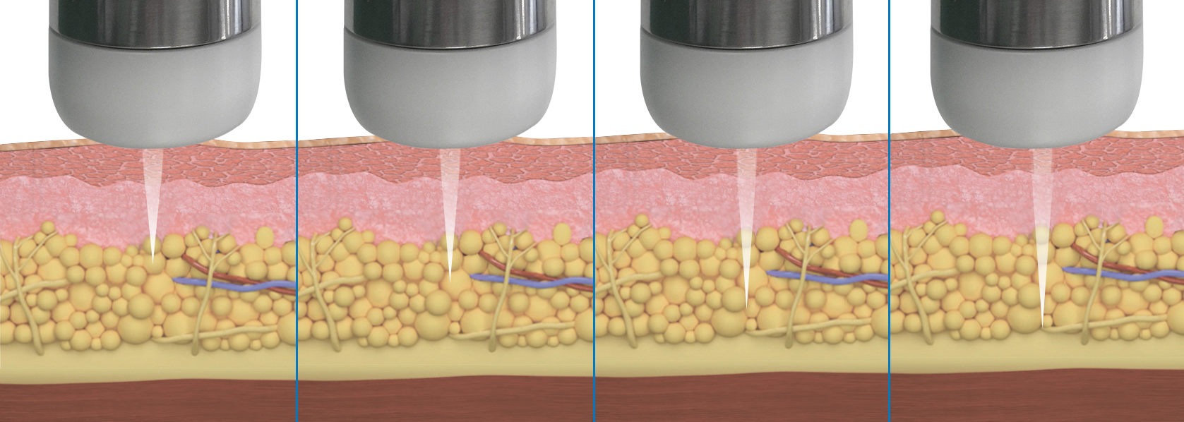 CFU-Èlife Ultrasonido Focalizado - Biotec Italia