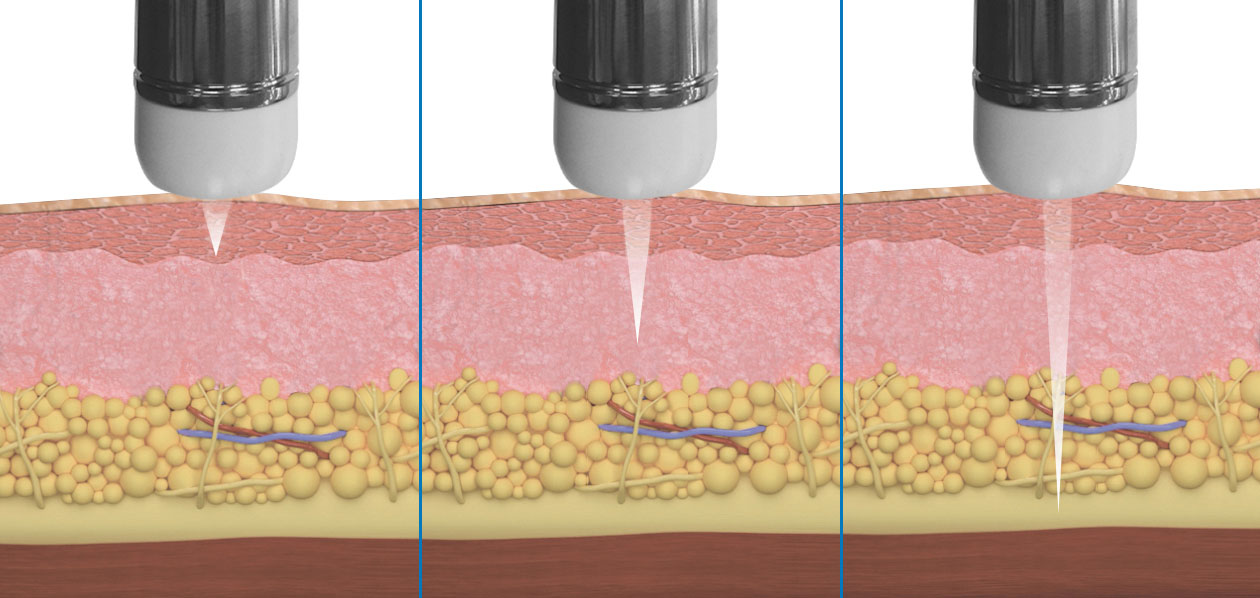 CFU-Èlife Ultrasonido Focalizado - Biotec Italia