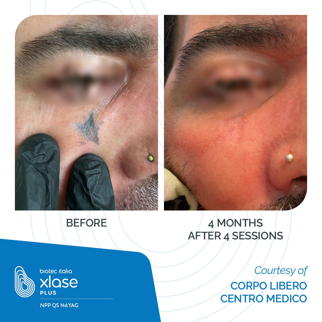 Xlase Plus - Biotec Italia