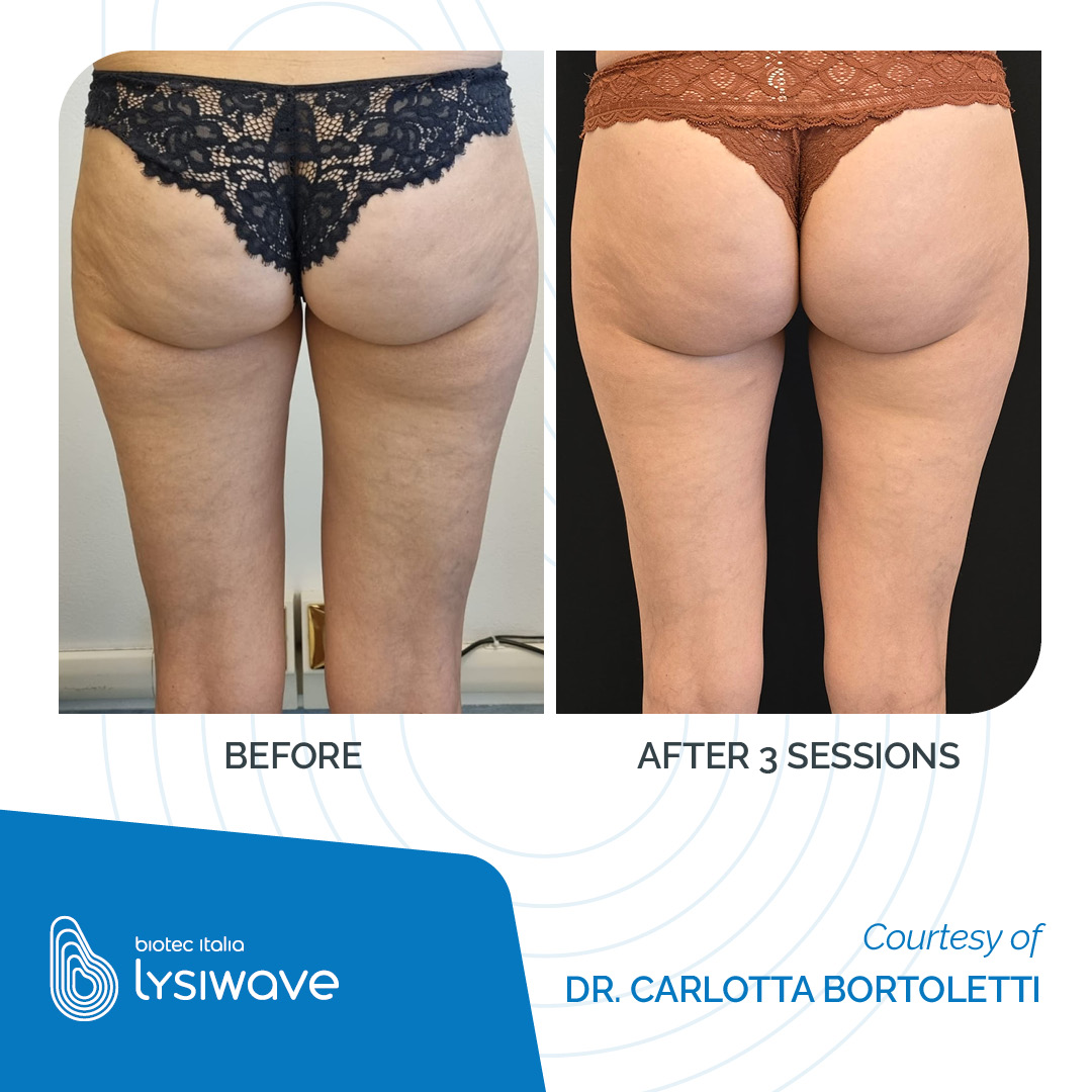 Lysiwave - Biotec Italia