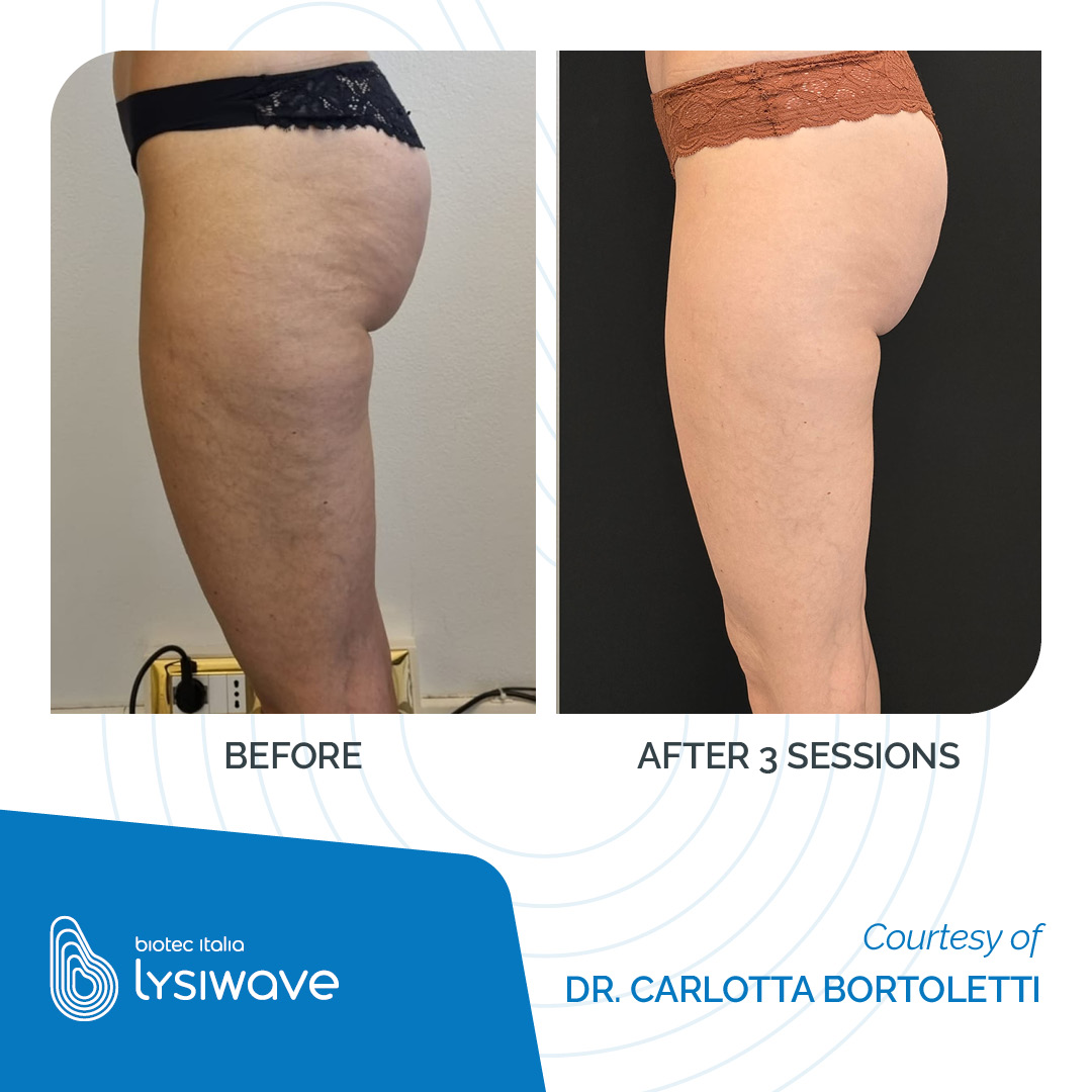 Lysiwave - Biotec Italia